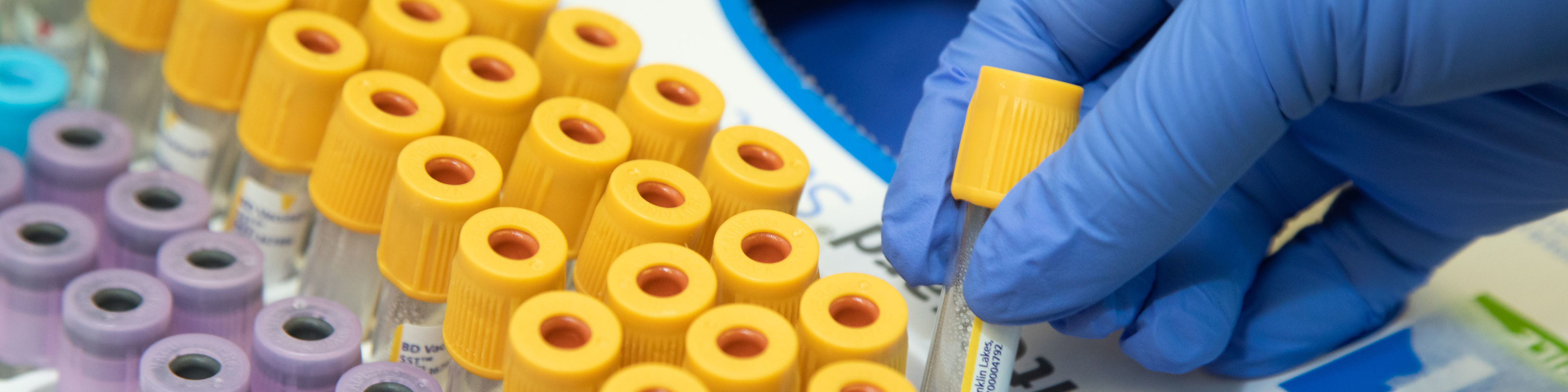 Diagnosing Prostate Cancer | USA Health